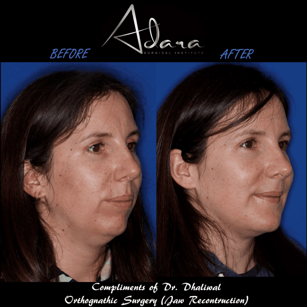 Is Jaw Surgery Right For You? Understanding Aftercare | Adara Surgical ...